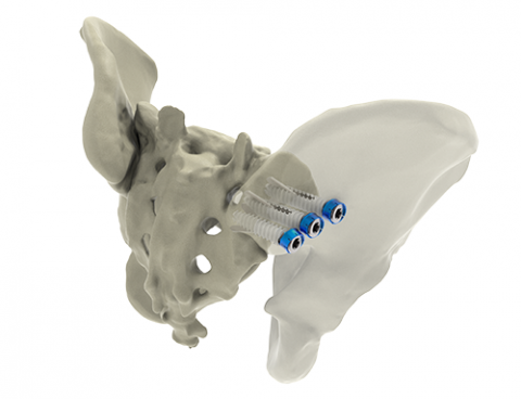 REX Ortho | Our Products | F-REX | L-REX